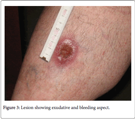 Cutaneous Leishmaniasis with Long Duration and Bleeding Ulcer