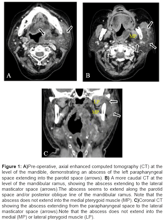 Unique Extension of Peritonsillar Abscess to the Masticator Space