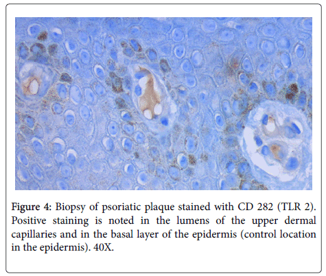 Psoriasis: A Sequela of Streptococcal Infection Similar to Acute