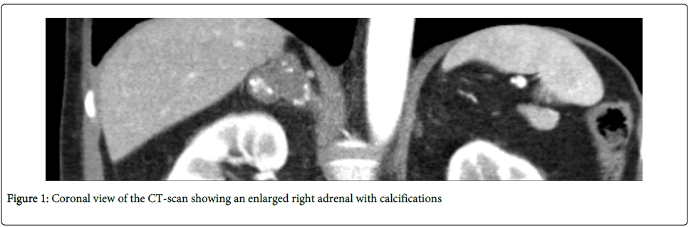 Addison’s Disease as Presenting Symptom of Infection with M. tuberculosis