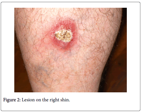 Cutaneous Leishmaniasis with Long Duration and Bleeding Ulcer