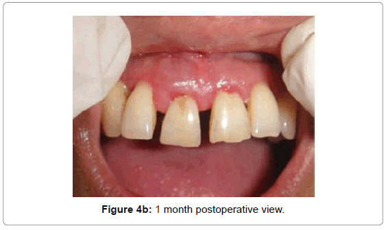 Comparative Results Of Frenectomy By Three Surgical Techniques ...