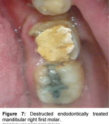 Dowel Core Techniques for Multi-rooted Teeth: Series of Three Cas
