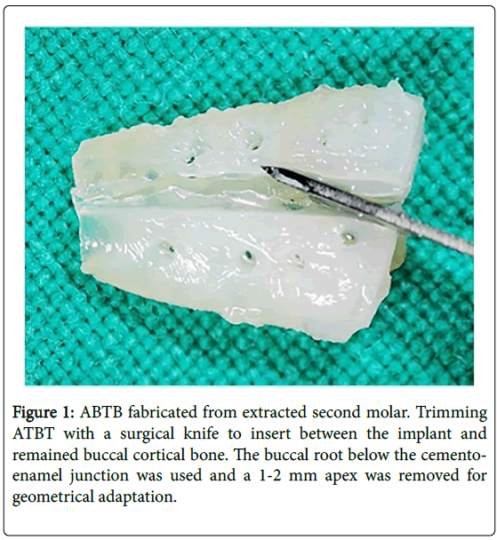 Autogenous Tooth Bone Graft Block For Socket Preservation: A One-Stage ...