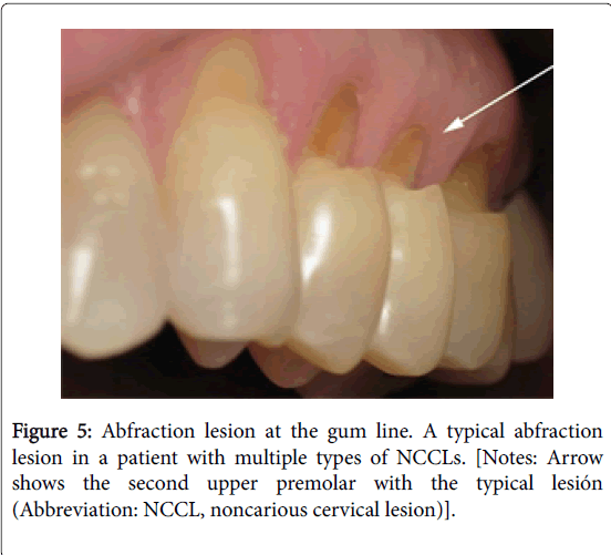 Noncarious Cervical Lesions as Abfraction: Etiology, Diagnosis, and ...