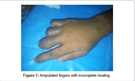A Cost Effective Method to Fabricate an Interim Finger Prosthesis