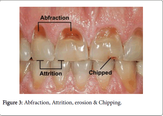 Noncarious Cervical Lesions as Abfraction: Etiology, Diagnosis, and ...