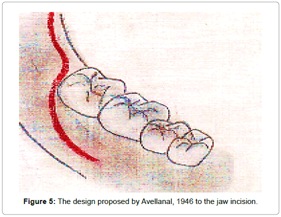 The Different Types of Flaps in the Surgical Relations of the Third ...