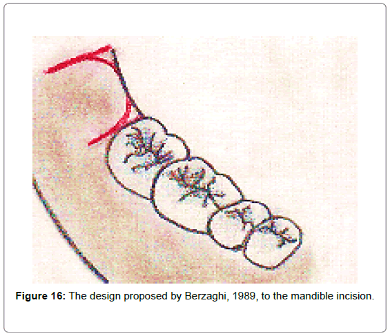 The Different Types of Flaps in the Surgical Relations of the Third ...