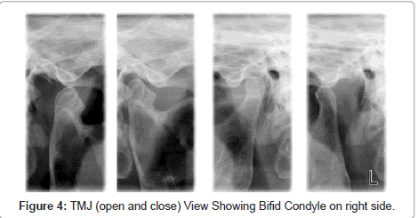 Morphological and Radiological Variations of Mandibular Condyles