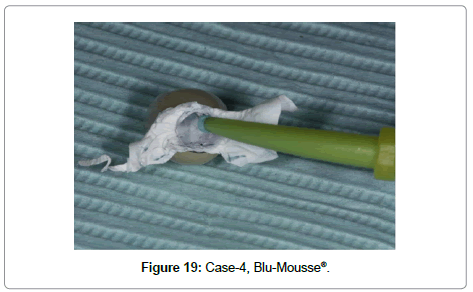 Retrospective on Treating Periimplantitis