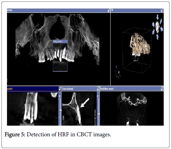 Cone Beam Computed Tomography and Digital Periapical Radiography in ...
