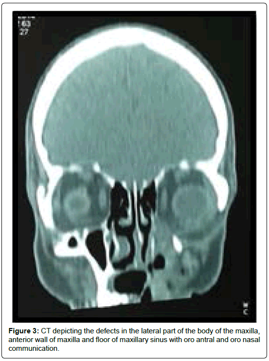Maxillary Osteomyelitis by Mucormycosis: A Case Report and Literature ...
