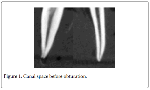 Evaluation Of Three Different Obturation Techniques Using Three-D