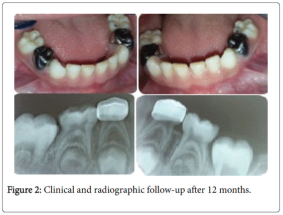 The Hall Technique: A Non-conventional Method for Managing Cariou