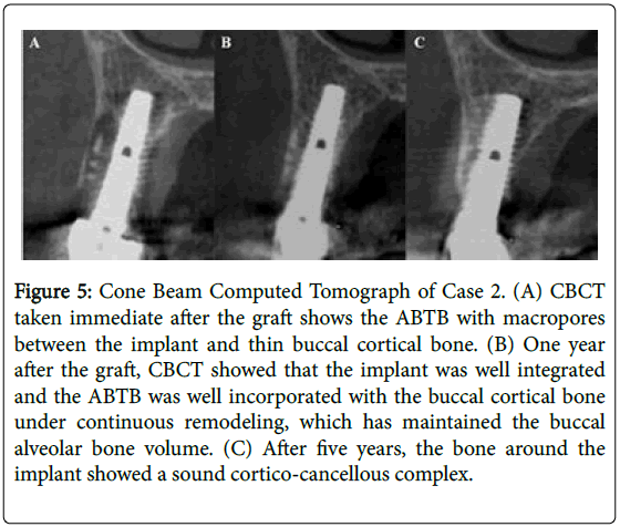 Autogenous Tooth Bone Graft Block For Socket Preservation: A One-Stage ...