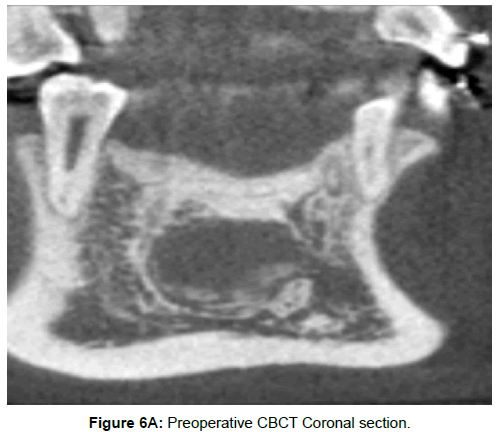 3D CBCT Superimposition Use in Evaluation of Simple Bone Cyst Lesion ...