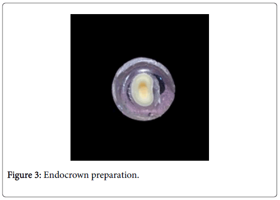 Fracture Resistance of Endodontically Treated Teeth Restored with