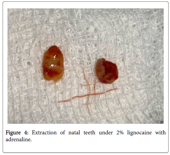 Natal Tooth-An Overview and A Case Report
