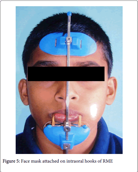 Treatment for Maxillary Hypoplasia in Skeletal Class III Patient