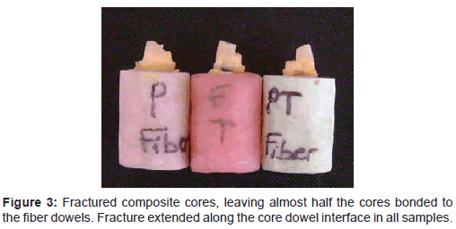 Effect of Dowel Material and Design on the Fracture Resistance of