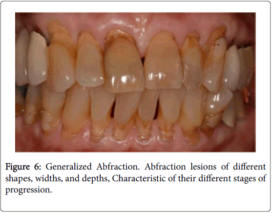 Noncarious Cervical Lesions as Abfraction: Etiology, Diagnosis, and ...