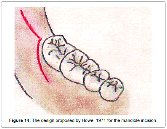 The Different Types of Flaps in the Surgical Relations of the Third ...