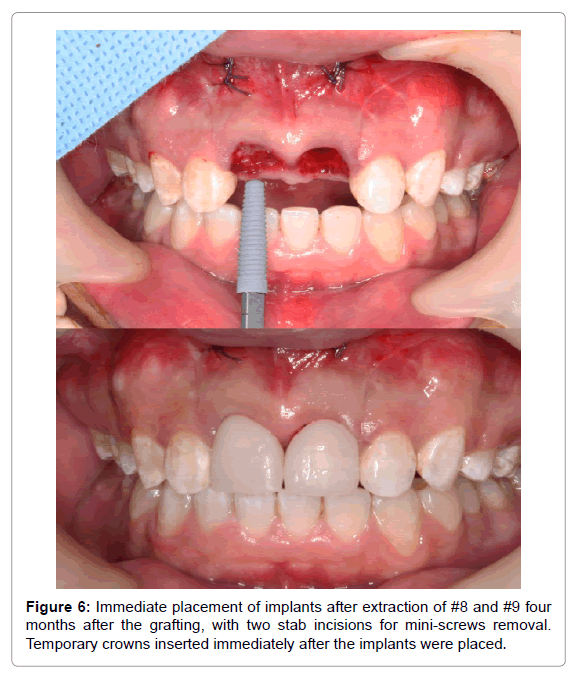 Socket Transformation: A Feasible Alternative before Immediate Im