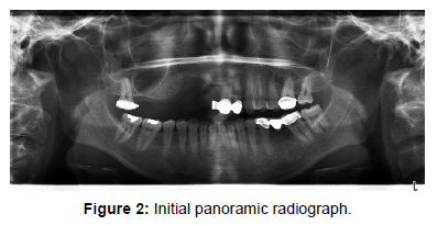 Prosthetic Management Of A Maxillary Alveolar Defect With An Impl