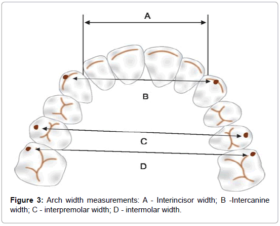 Sex Estimation by Odontometric Study of the Maxillary Canine Teeth ...