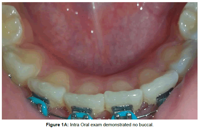 3D CBCT Superimposition Use in Evaluation of Simple Bone Cyst Lesion ...