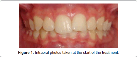 Evaluation Of Dentofacial Changes Caused With Sabbagh Universal Spring ...