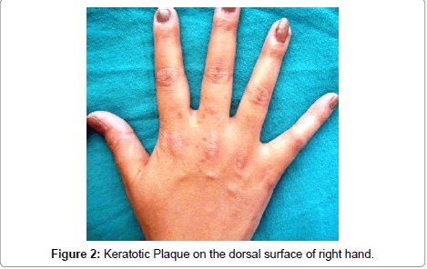 Papillon Lefevre Syndrome: a case report with review
