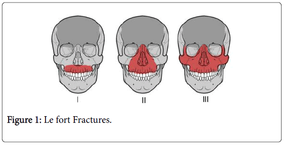 Use of Mandibulo-Maxillary Fixation Screws for the Treatment of ...