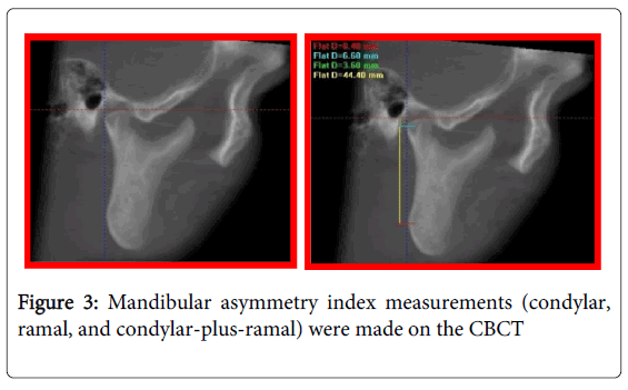 Evaluation of Condylar and Ramal Asymmetry on Patients with Ectod