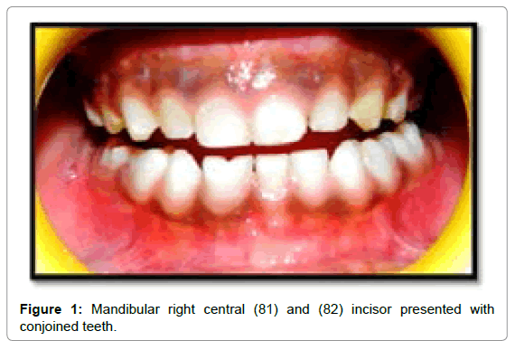 Gemination Or Fusion? A Diagnostic Dilemma