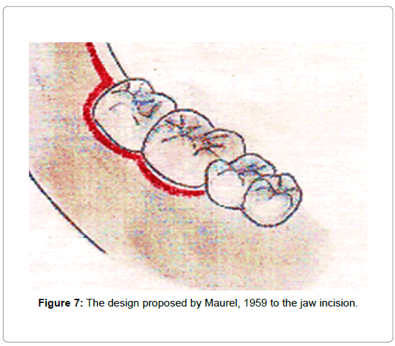 The Different Types of Flaps in the Surgical Relations of the Third ...