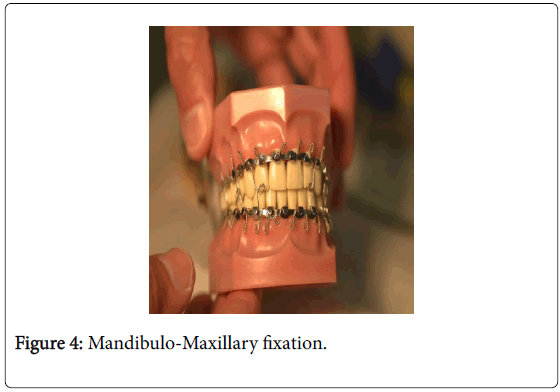 Use of Mandibulo-Maxillary Fixation Screws for the Treatment of ...