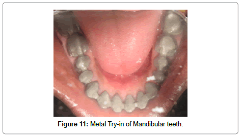 Restoring Esthetics and Function in a Patient with Amelogenesis I