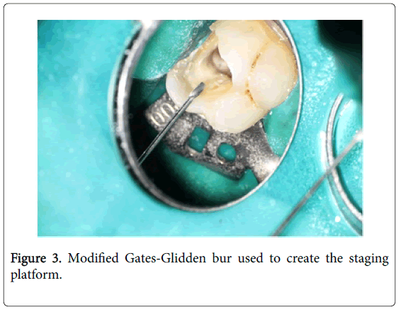 The Use Of Miller Broach During Microsonic Removal Of Separated ...
