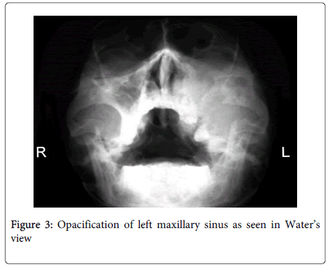 Primary Sinus Carcinoma Masquerading as Destructive Periodontitis ...
