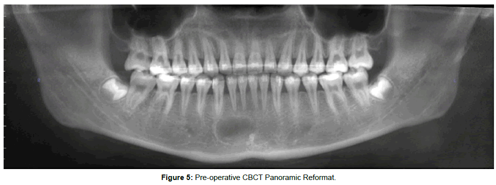 3D CBCT Superimposition Use in Evaluation of Simple Bone Cyst Lesion ...