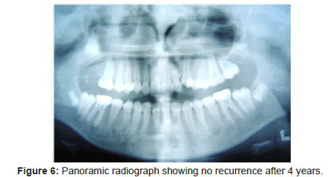 Odontoameloblastoma: Report of a Case