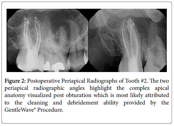 Complex Apical Anatomy Revealed Following Endodontic Treatment of