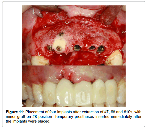Socket Transformation: A Feasible Alternative before Immediate Im