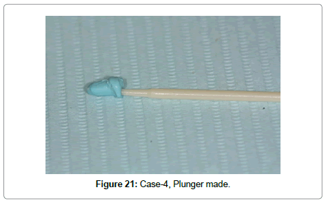 Retrospective on Treating Periimplantitis