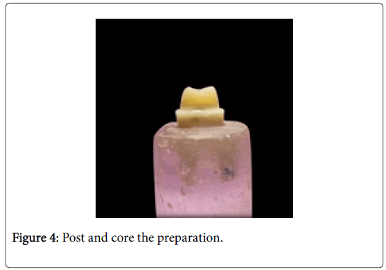 Fracture Resistance of Endodontically Treated Teeth Restored with