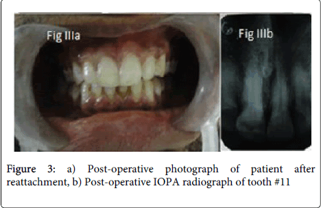 Bio-Esthetic Restoration: A Novel Approach In Conservative Dentistry