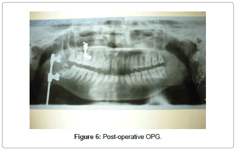 Treatment of Condylar Hypoplasia and Occlusal Cant Using Simultaneous ...