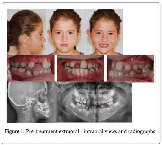Management of Class III Malocclusion with Missing a Maxillary Cen